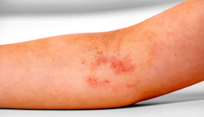 Campaña de detección gratuita de dermatitis atópica - ANDigital